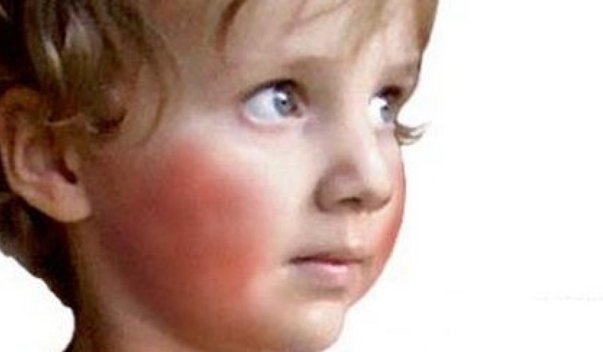 Kildare school sends text to parents about Slapped Cheek Disease ...