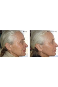 A little insight into the only Lipofirm Pro Trilipo treatments in ...